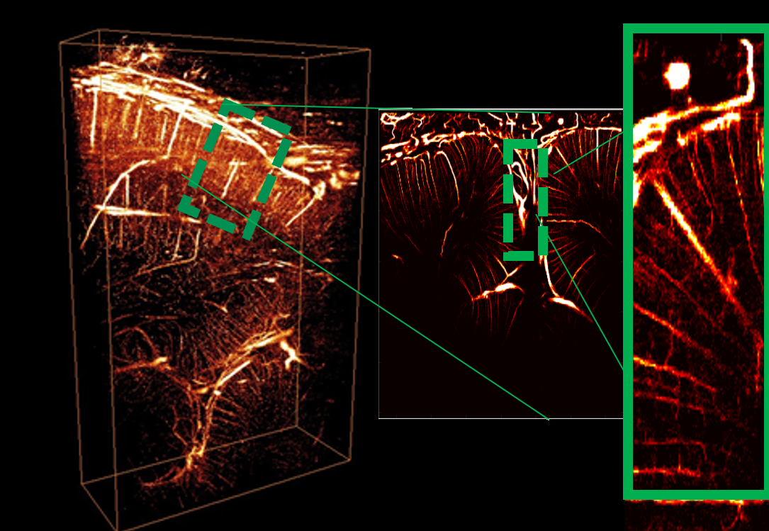 Quels sont les traitements du tremblement essentiel